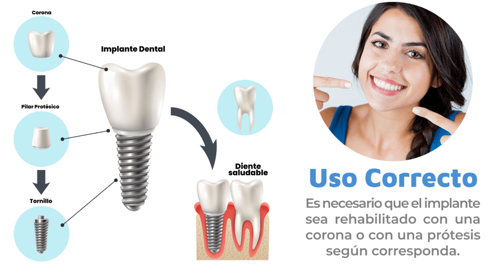 Implantes Dentales – Clinica Dental Concepción